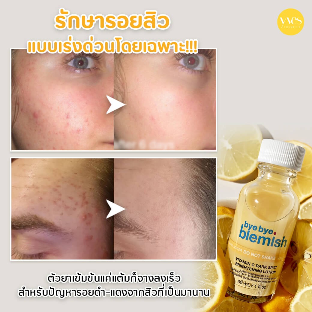 bye bye blemish Vitamin C Dark Spot Brightening Lotion | Yvescosmetic