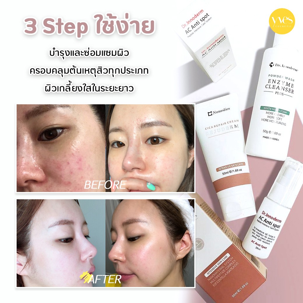 Dr.Innoderm 3 Step Miracle Set For Acne | Yvescosmetic